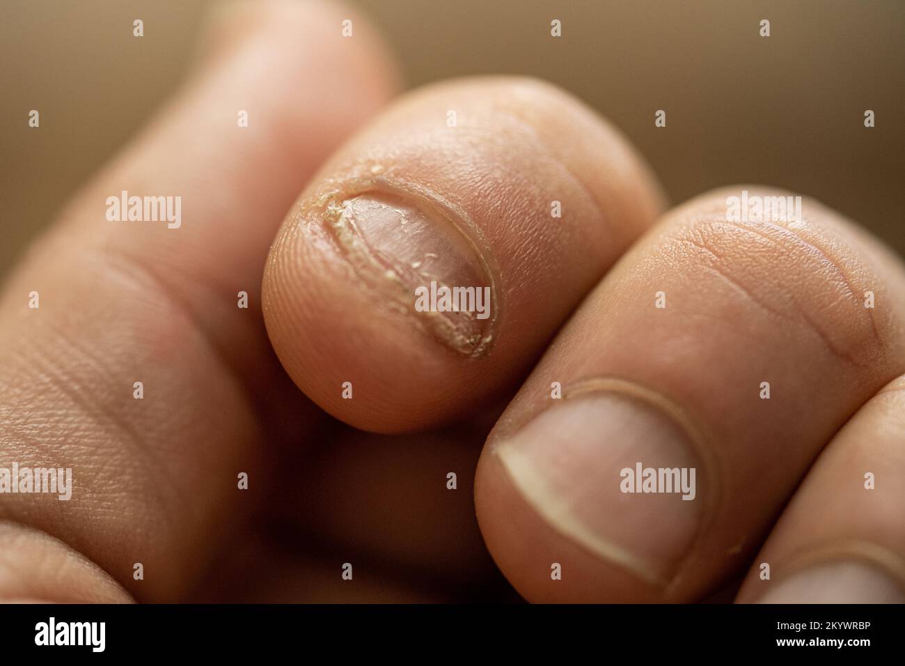 Onychophagy hi-res stock photography and images - Alamy