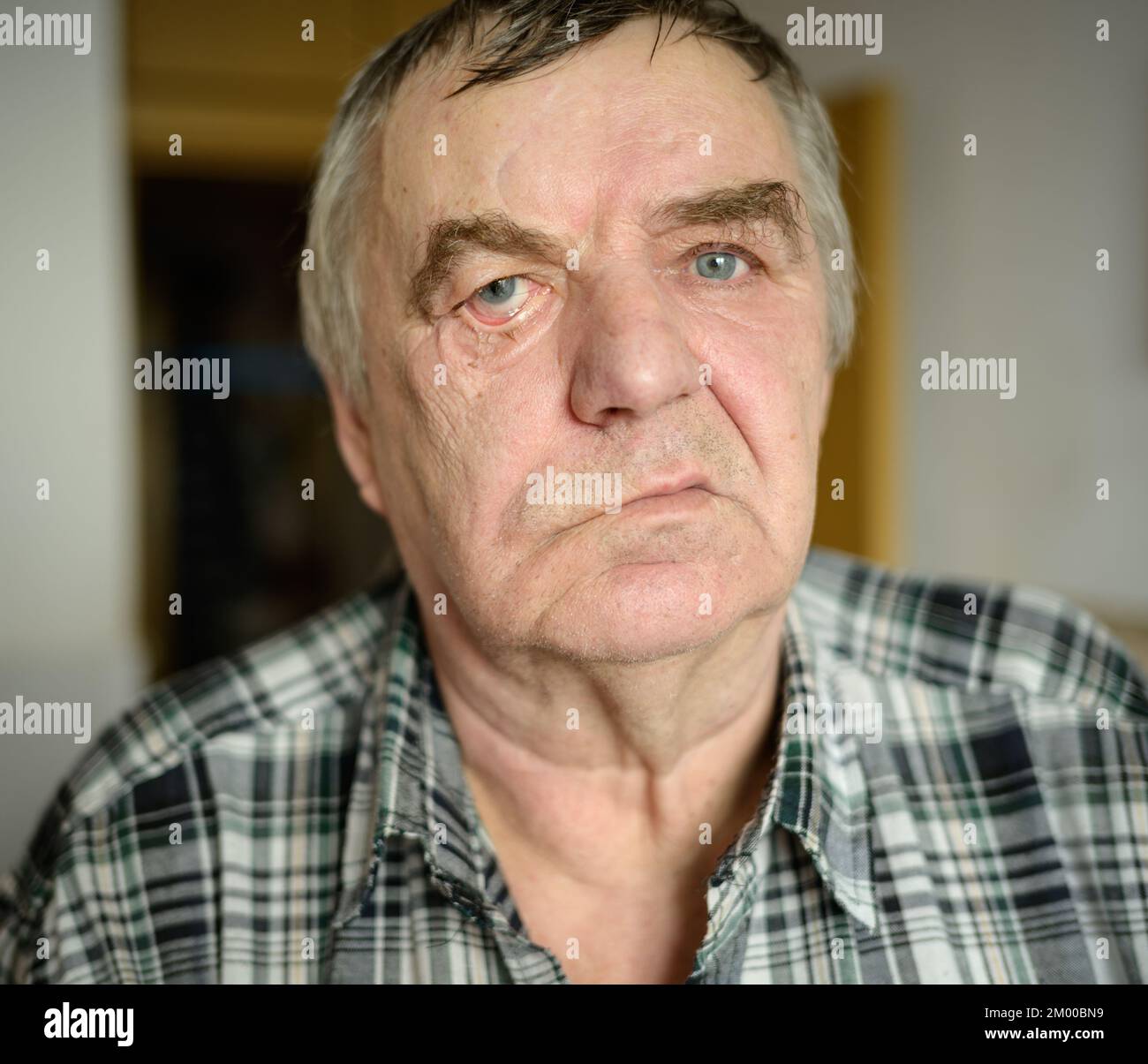 Aged man with facial nerve paralysis, Bell's palsy Stock Photo - Alamy