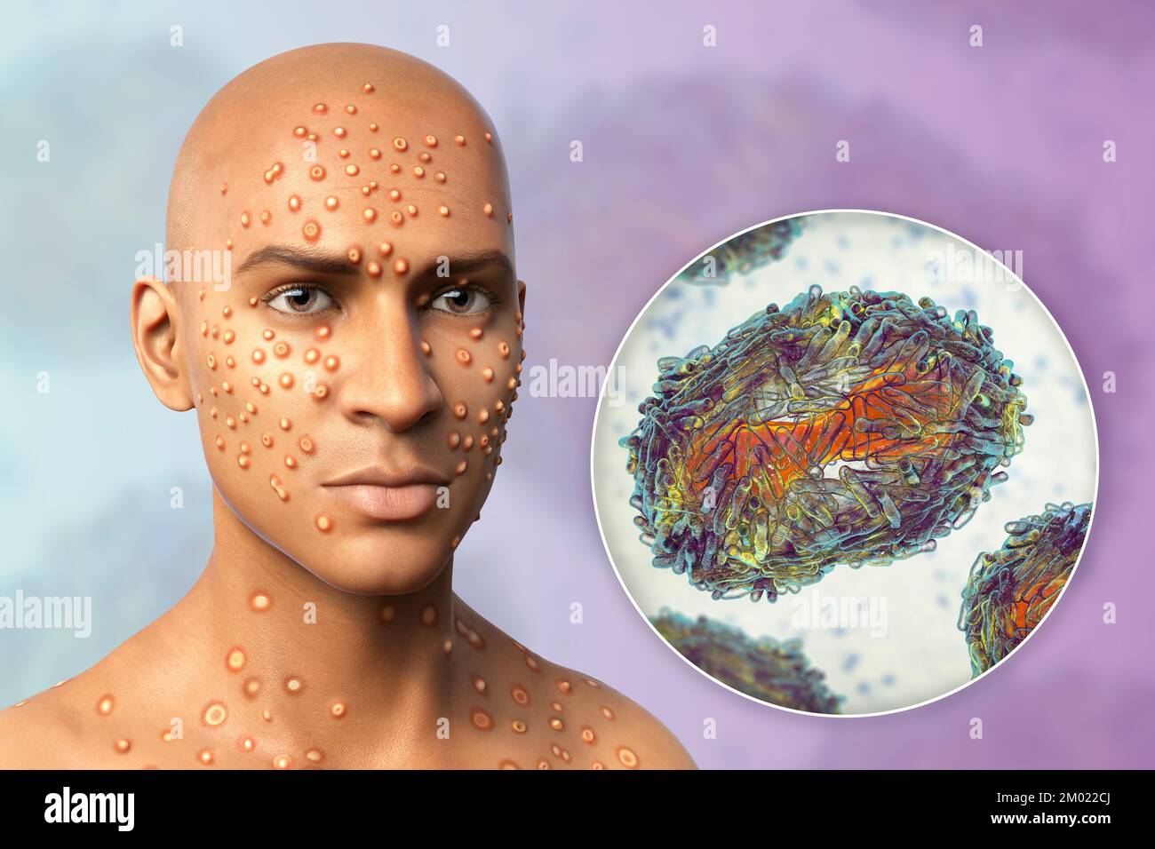 Monkeypox infection, illustration Stock Photo - Alamy