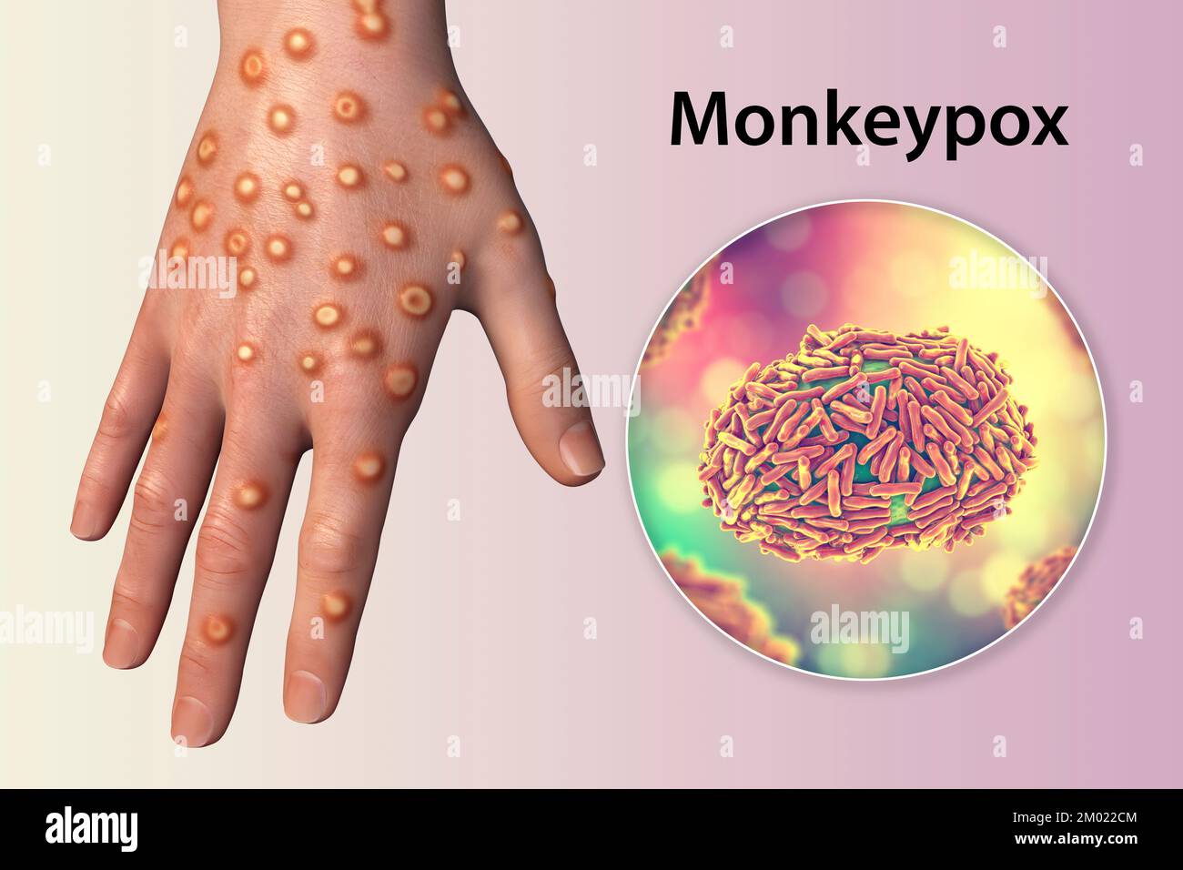 Monkeypox infection, illustration Stock Photo - Alamy