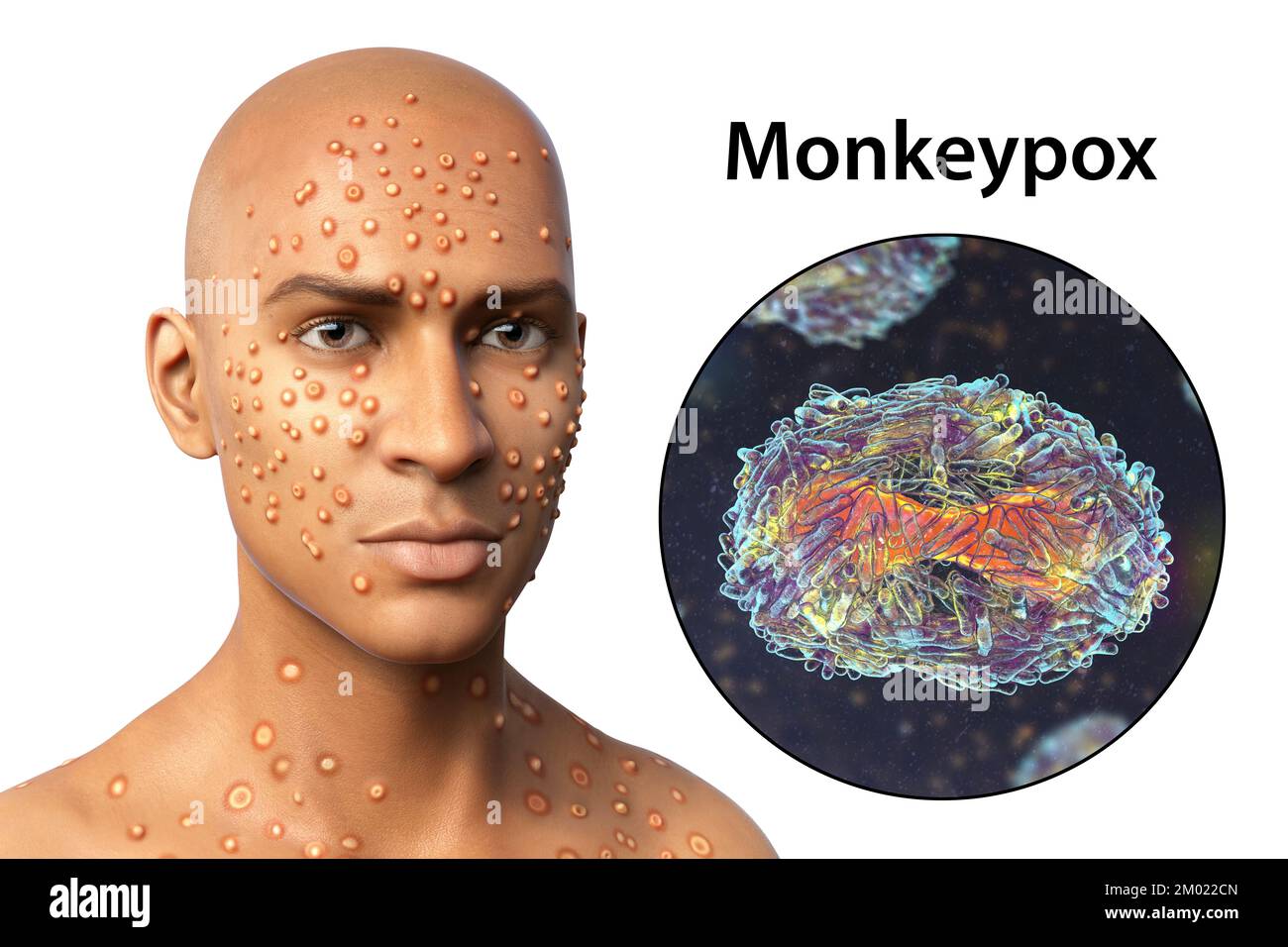 Monkeypox infection, illustration Stock Photo - Alamy