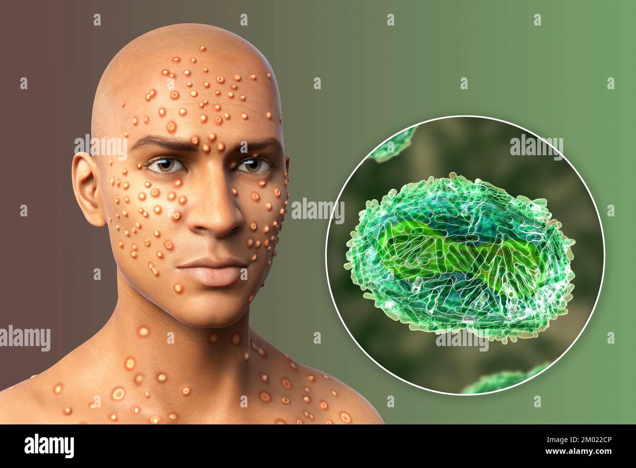 Monkeypox infection, illustration Stock Photo - Alamy