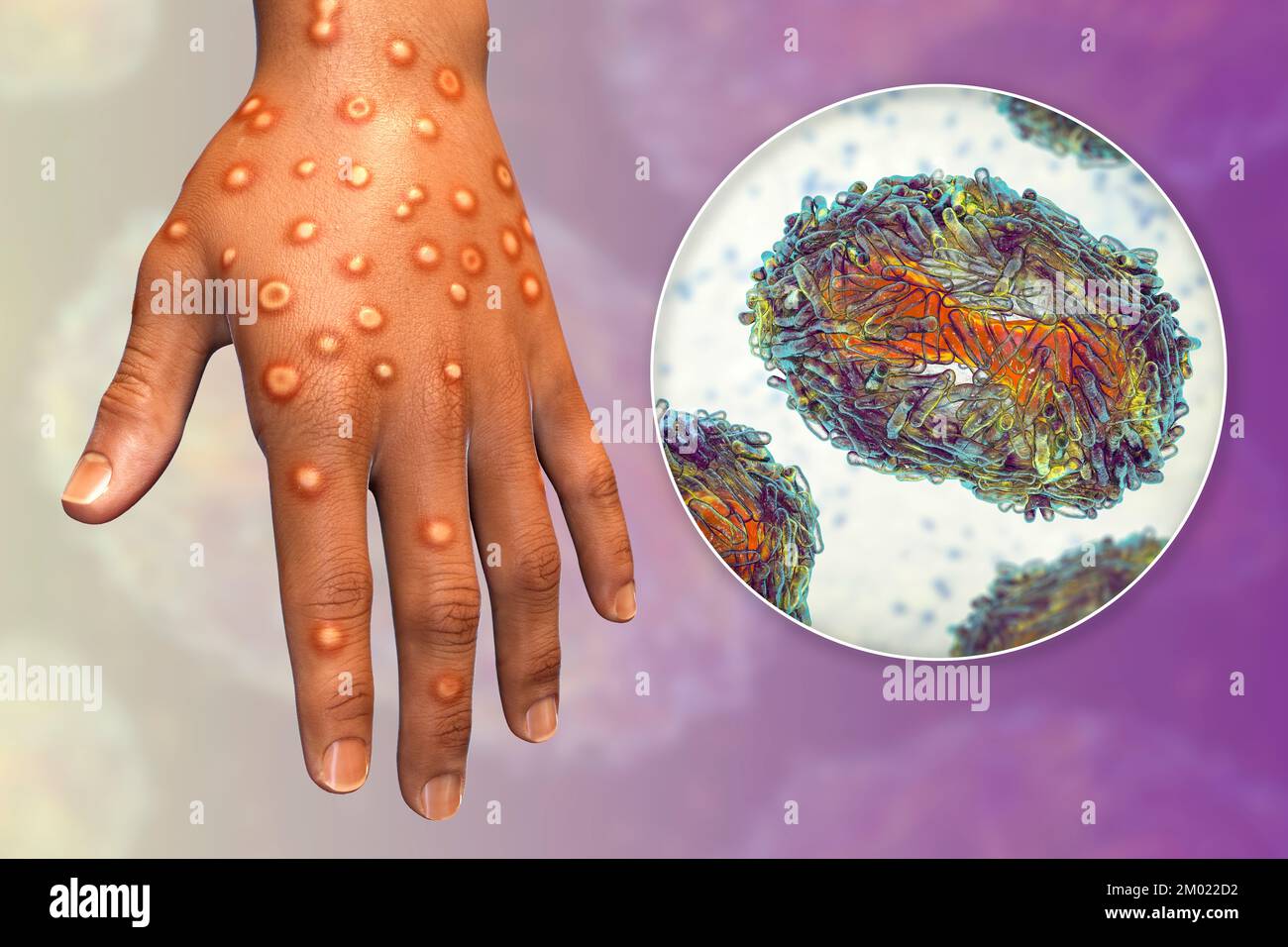 Monkeypox infection, illustration Stock Photo - Alamy