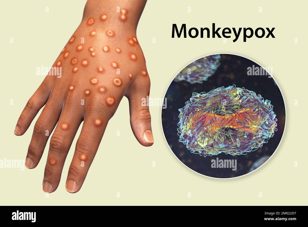 Monkeypox infection, illustration Stock Photo - Alamy