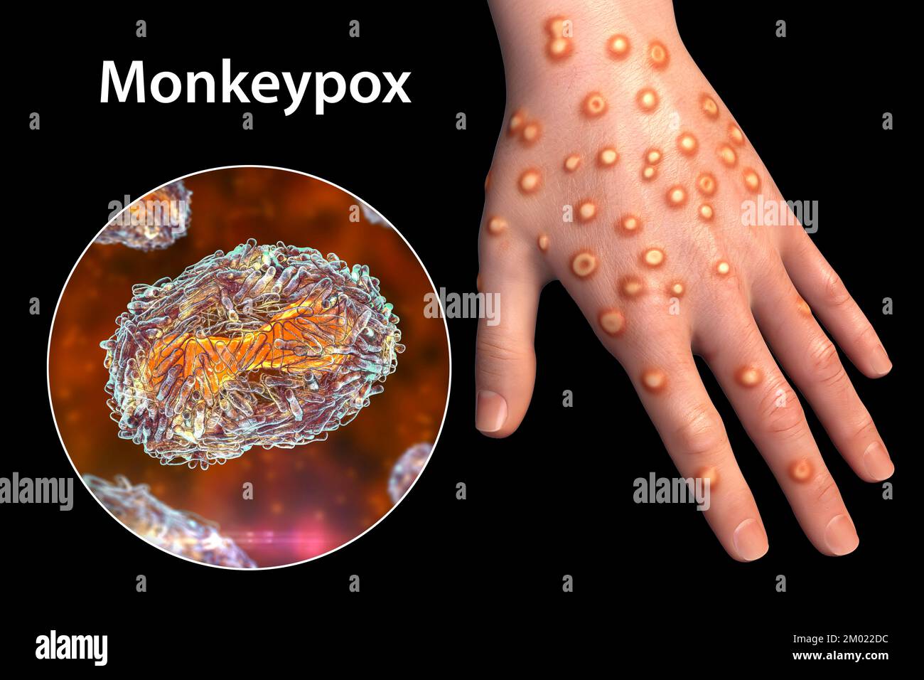 Monkeypox infection, illustration Stock Photo - Alamy