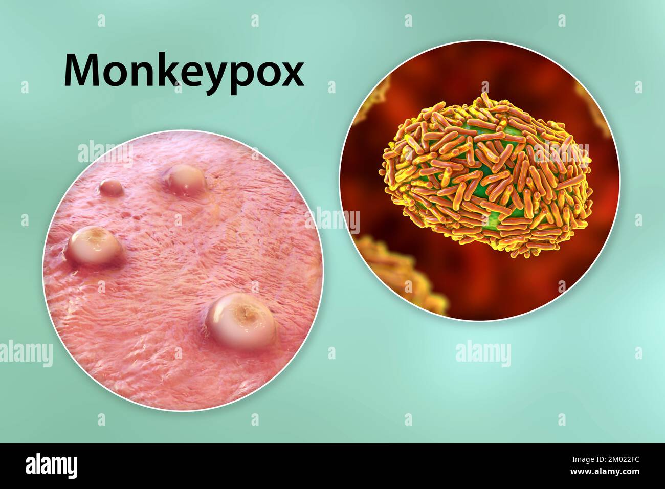 Monkeypox infection and virus, illustration Stock Photo - Alamy