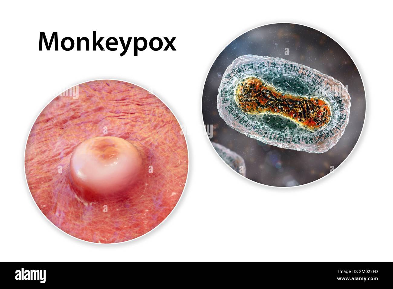 Monkeypox infection and virus, illustration Stock Photo - Alamy