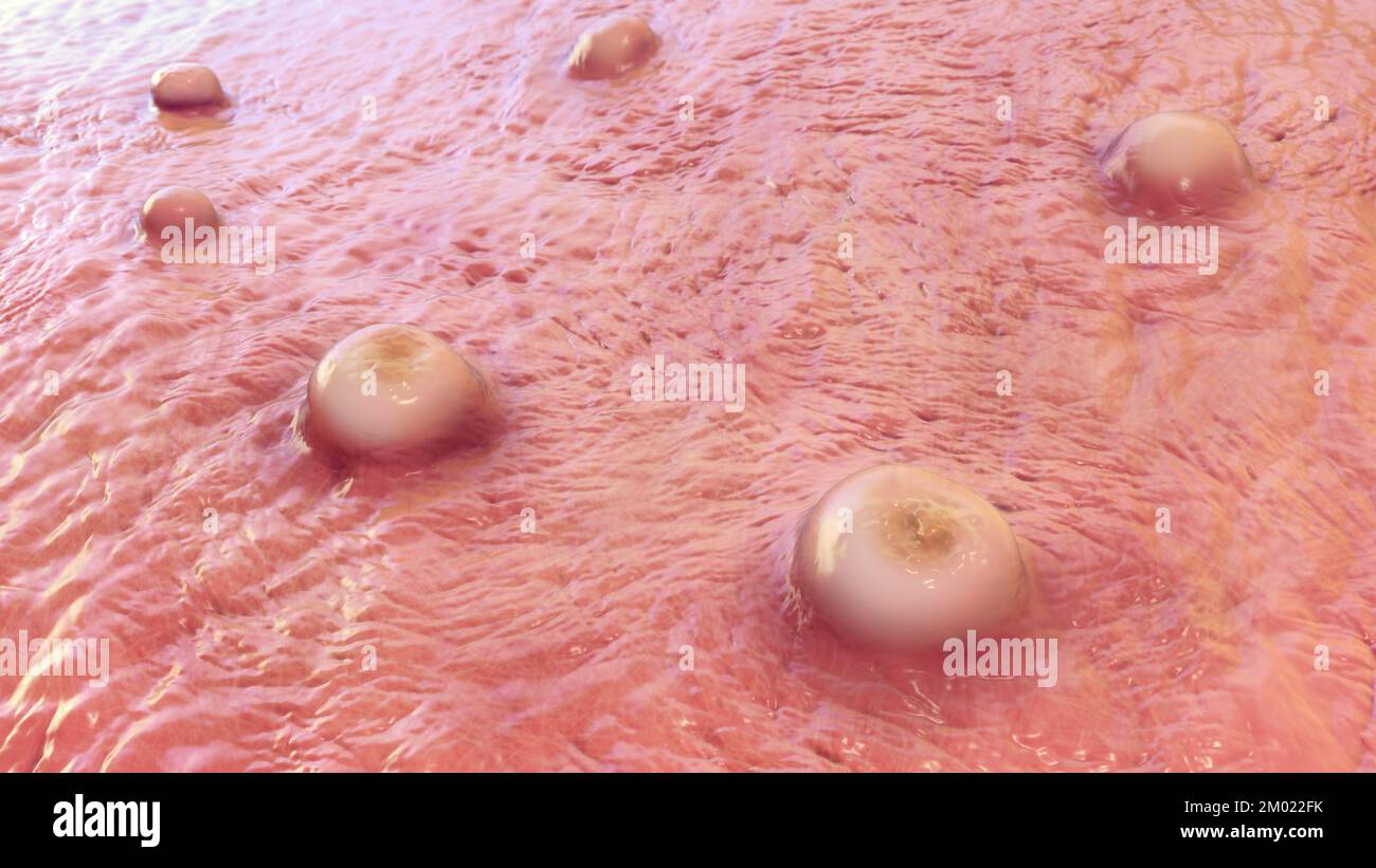 Skin lesions in monkeypox infection, illustration Stock Photo - Alamy