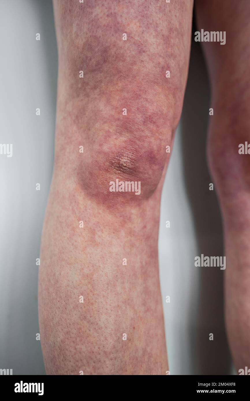 Cutaneous manifestations hi-res stock photography and images - Alamy