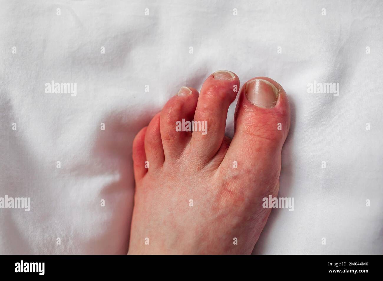 Chilblains On Toes Red Itchy Bumps Swelling Foot Of Person With Raynauds Phenomenon And