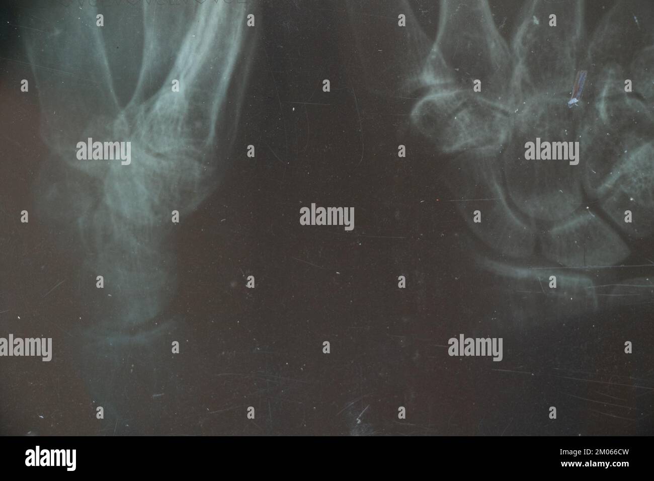 X-ray of an elderly person with osteoporosis and arthritis arthrosis ...