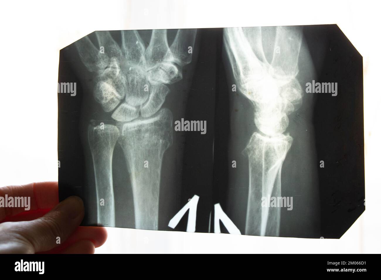 X-ray of an elderly person with osteoporosis and arthritis arthrosis ...