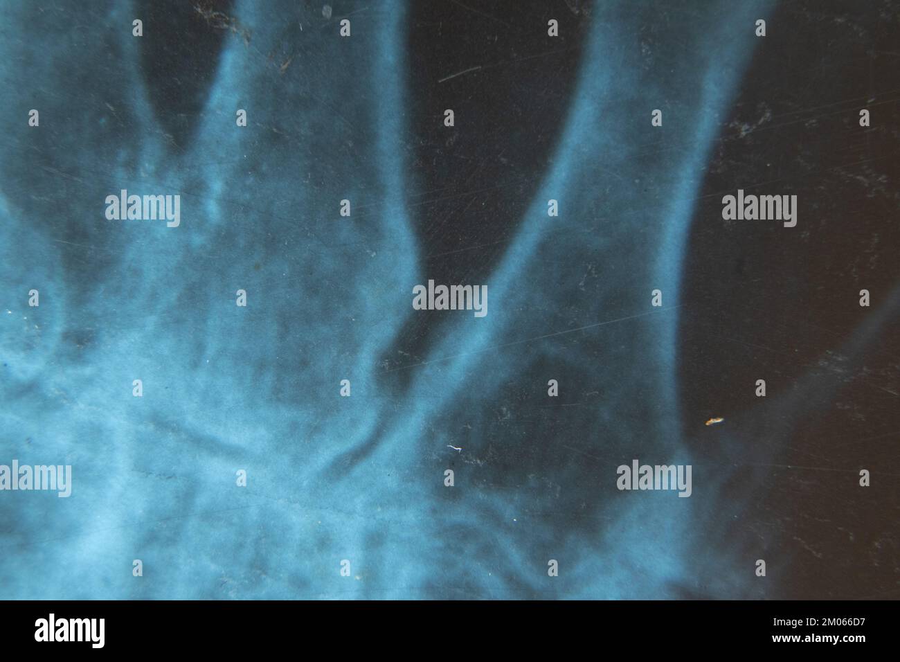 X-ray of an elderly person with osteoporosis and arthritis arthrosis ...