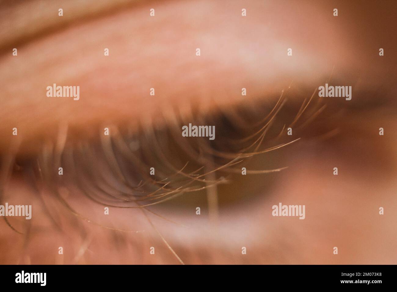 Upper eyelid surgery hi-res stock photography and images - Alamy