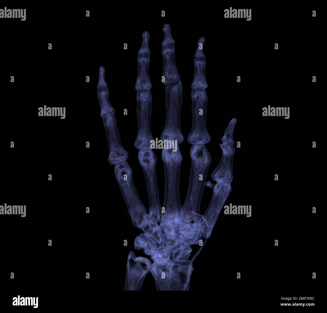 Rheumatoid arthritis hands hi-res stock photography and images - Alamy