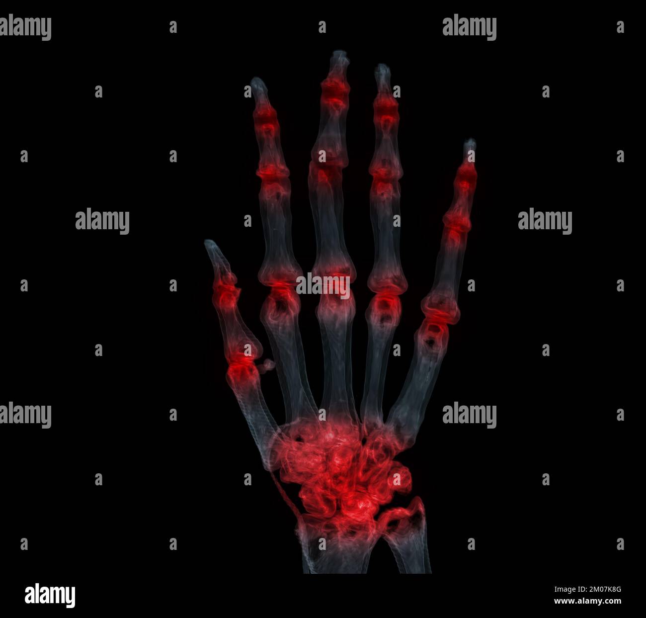 Transparent arthritis hi-res stock photography and images - Alamy