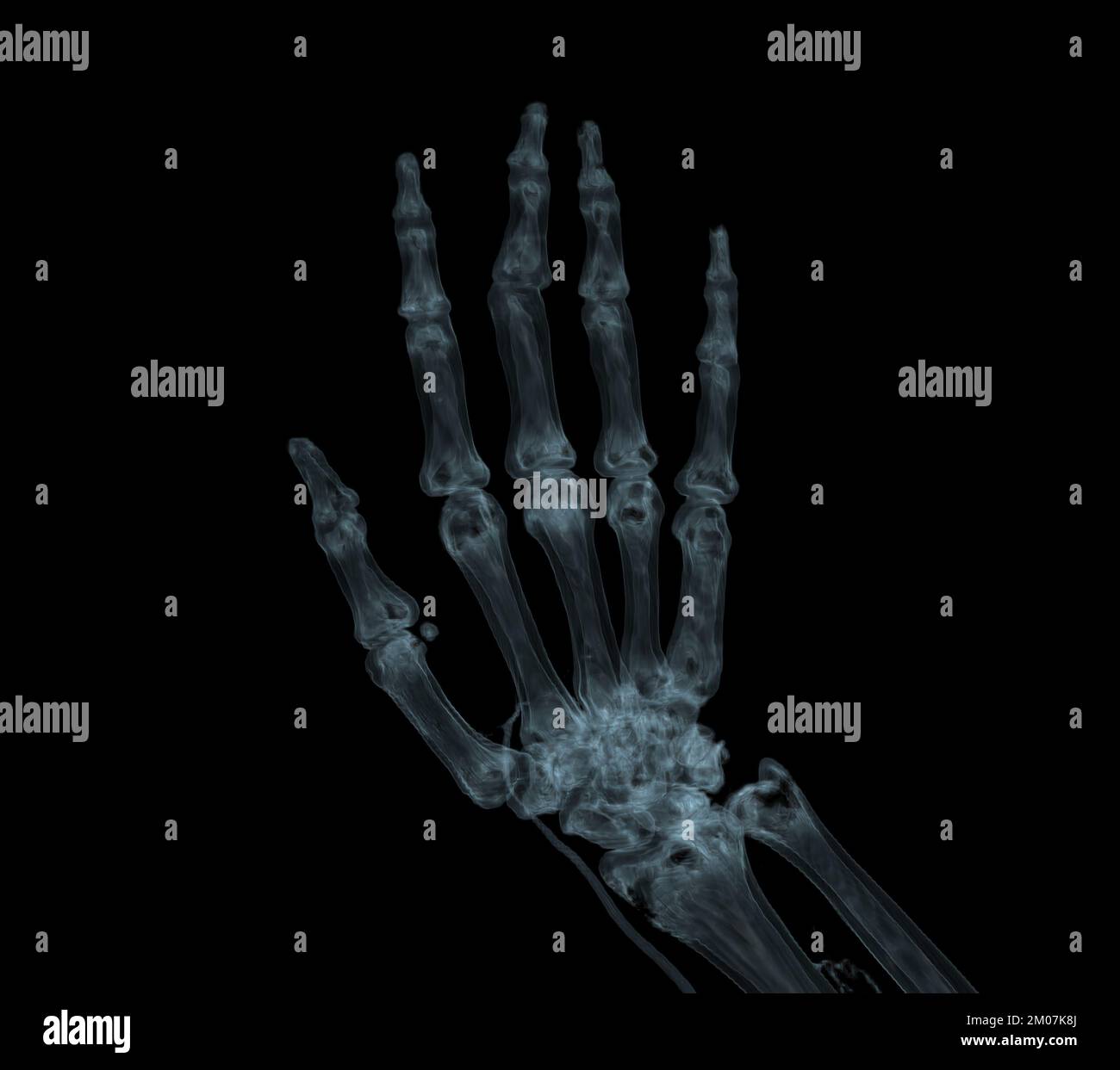 Hand 3D rendering for rheumatoid arthritis Concept Stock Photo - Alamy
