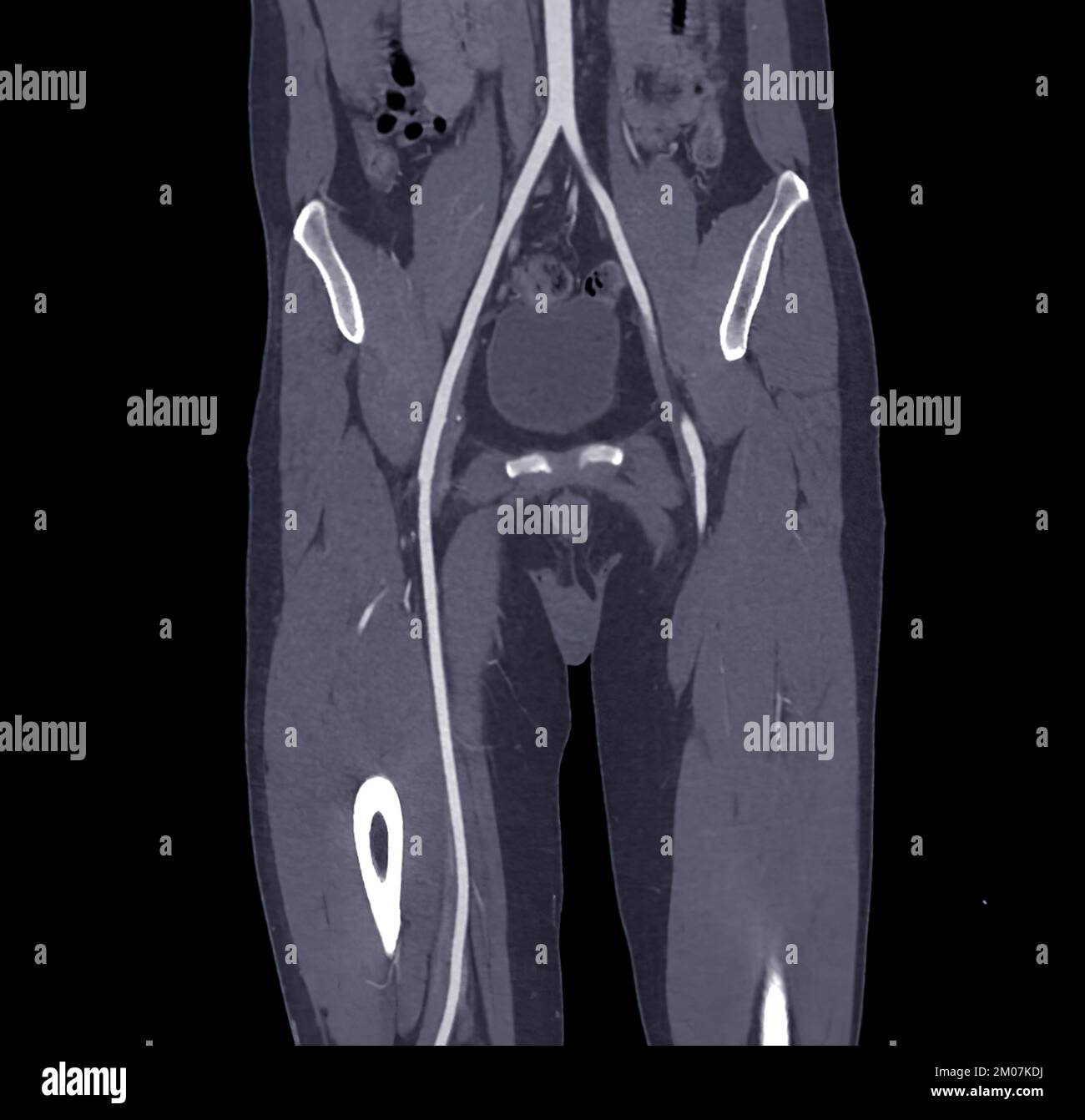 CTA femoral artery run off image of femoral artery for diagnostic Acute ...