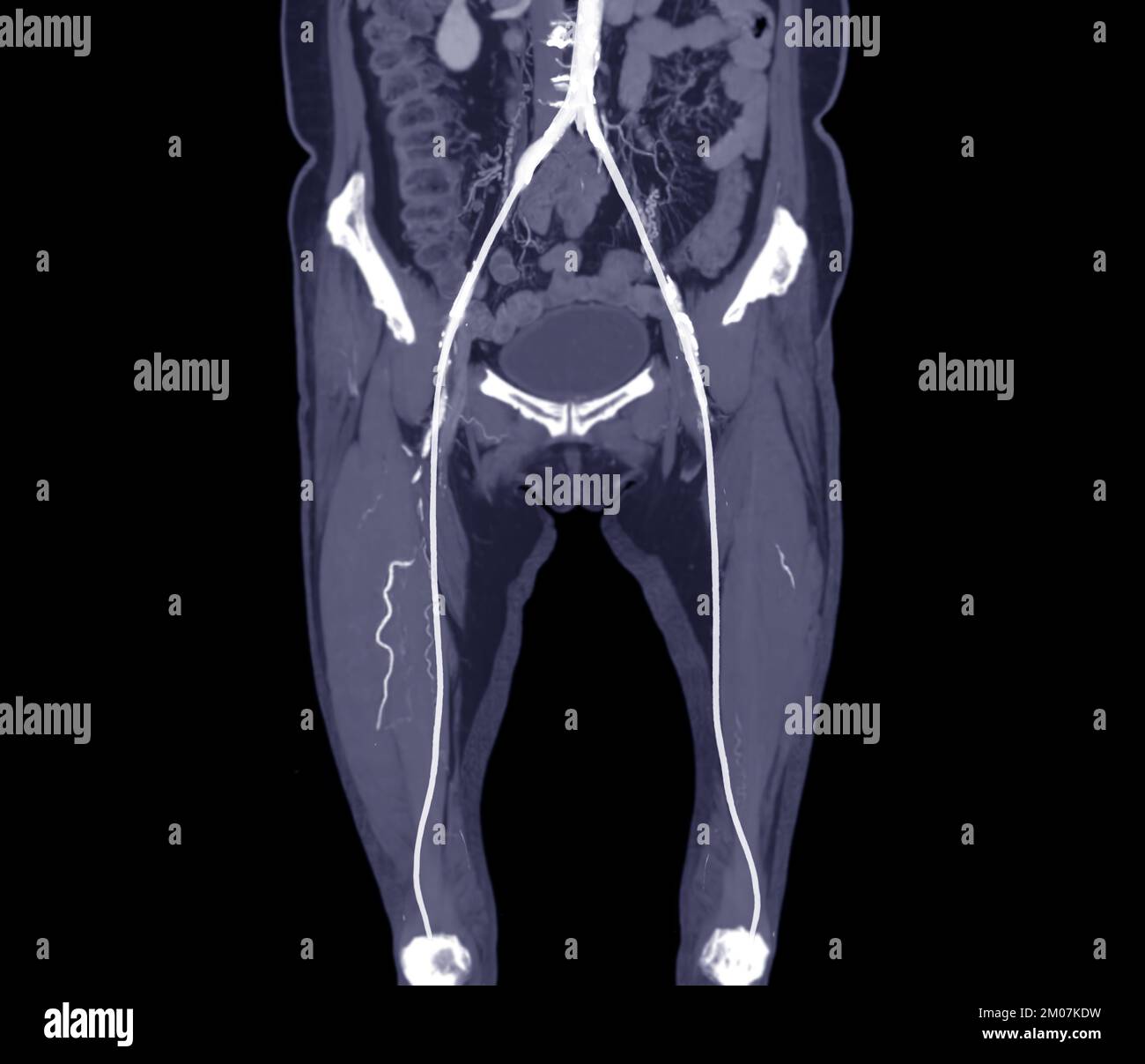 CTA femoral artery run off image of femoral artery for diagnostic Acute ...
