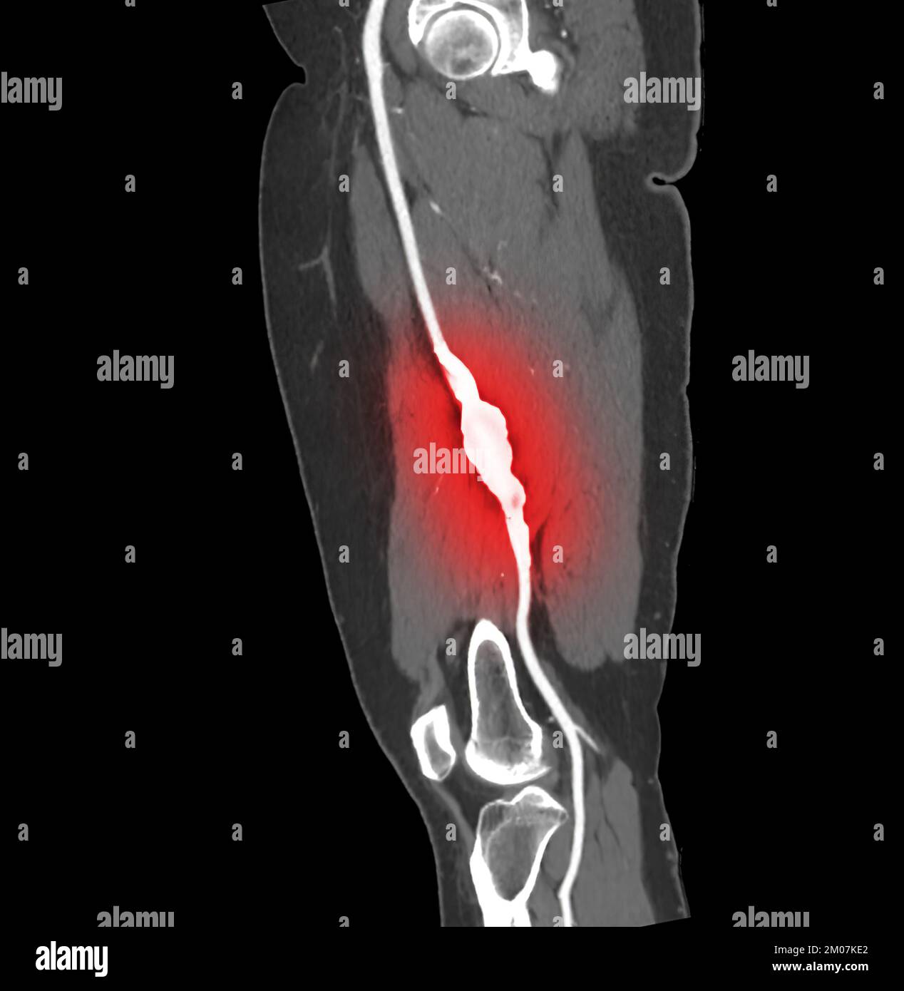 CTA femoral artery run off image of femoral artery for diagnostic Acute ...
