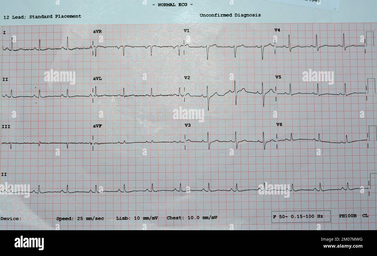 An ElectroCardioGraph ECG, a chart that draws the electricity of the ...