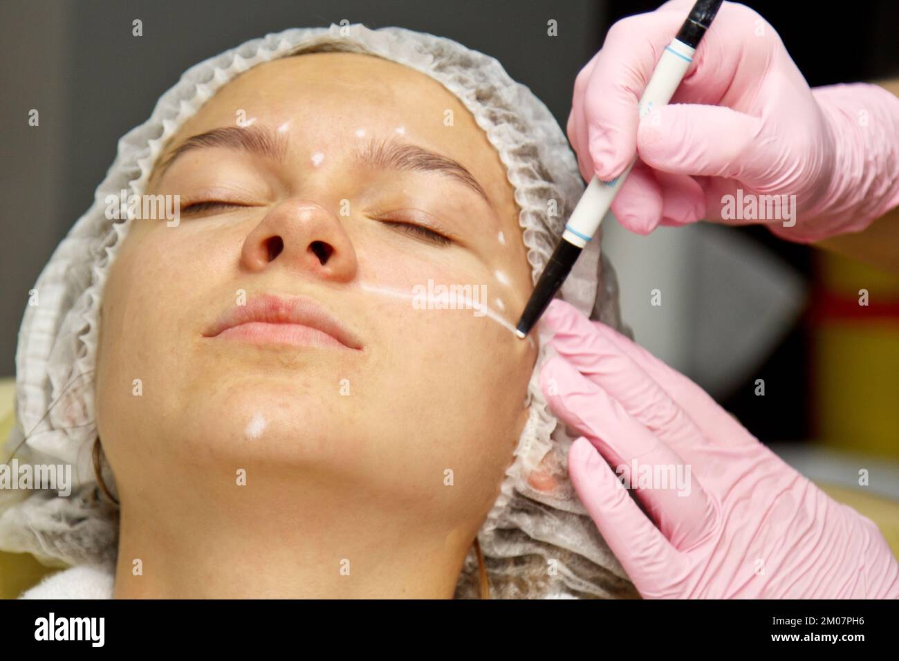 Attractive girl patient with instructions on her face for plastic ...