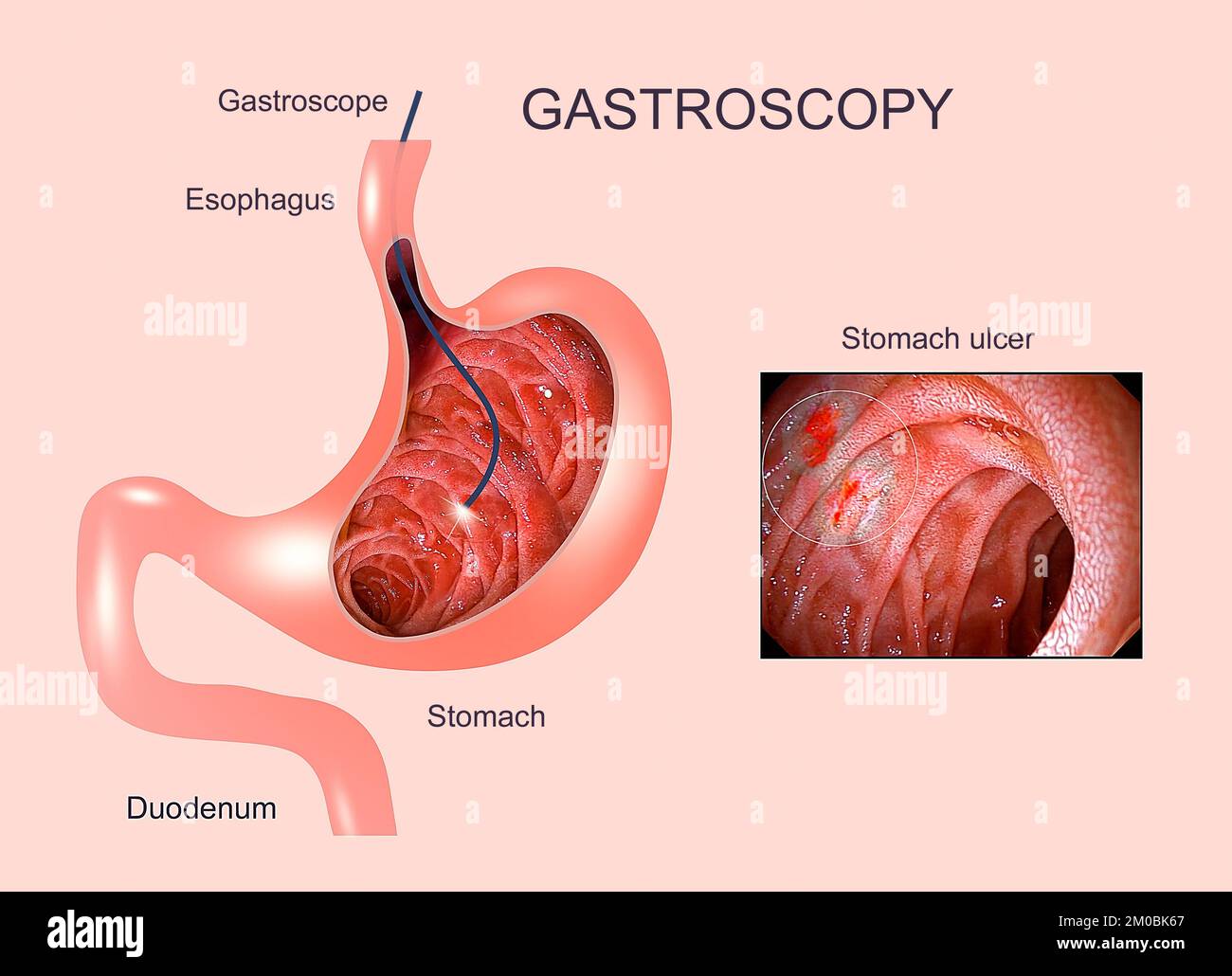 Upper Endoscopy Ulcer