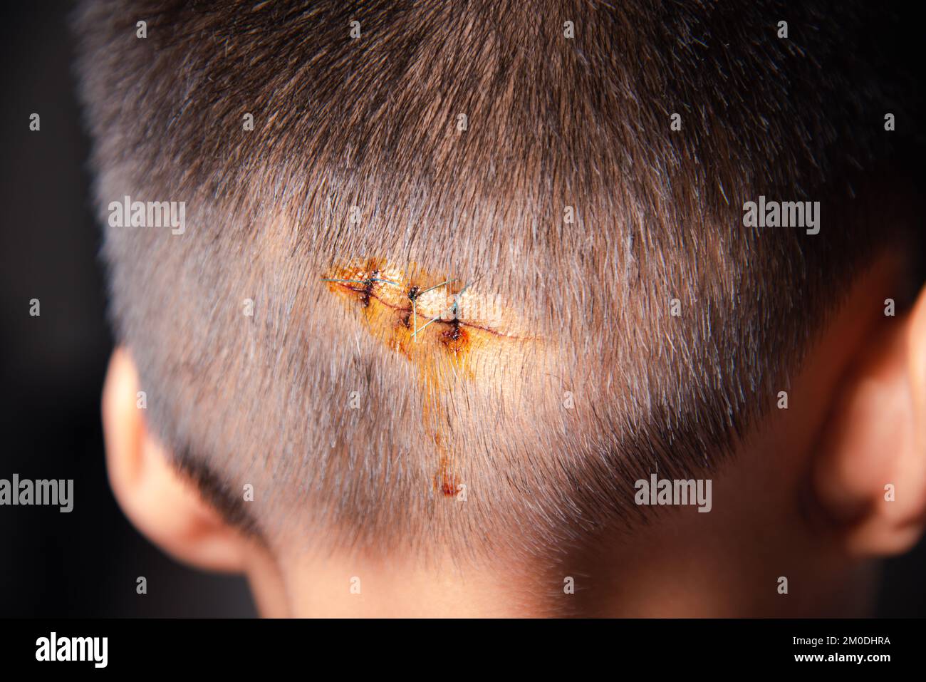 The lacerated suture wound of head which suture by nylion suture about ...