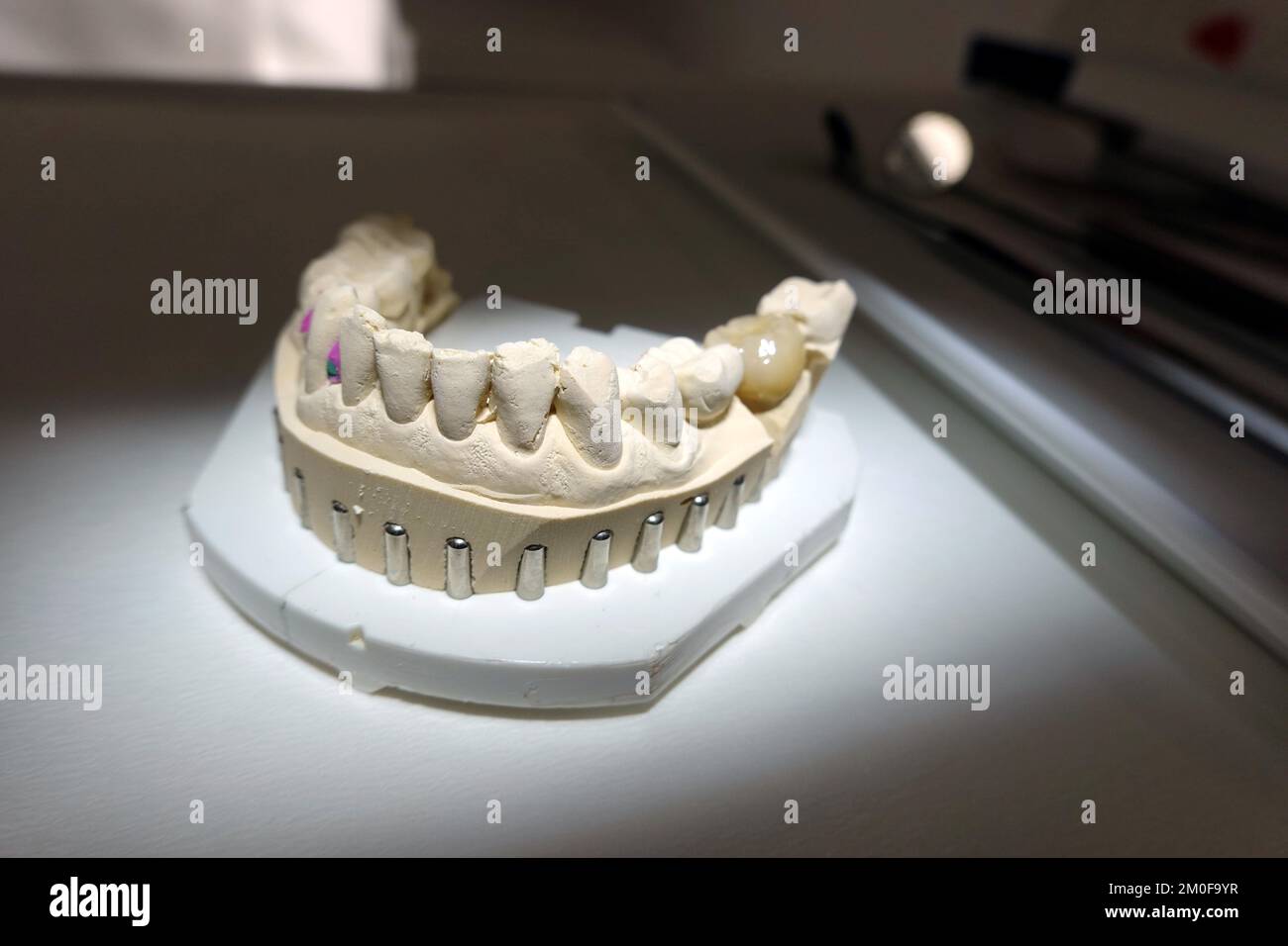 plaster cast of teeth with a dental crown Stock Photo - Alamy