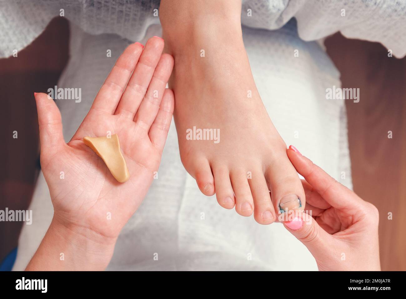 Toenail bracket hi-res stock photography and images - Alamy
