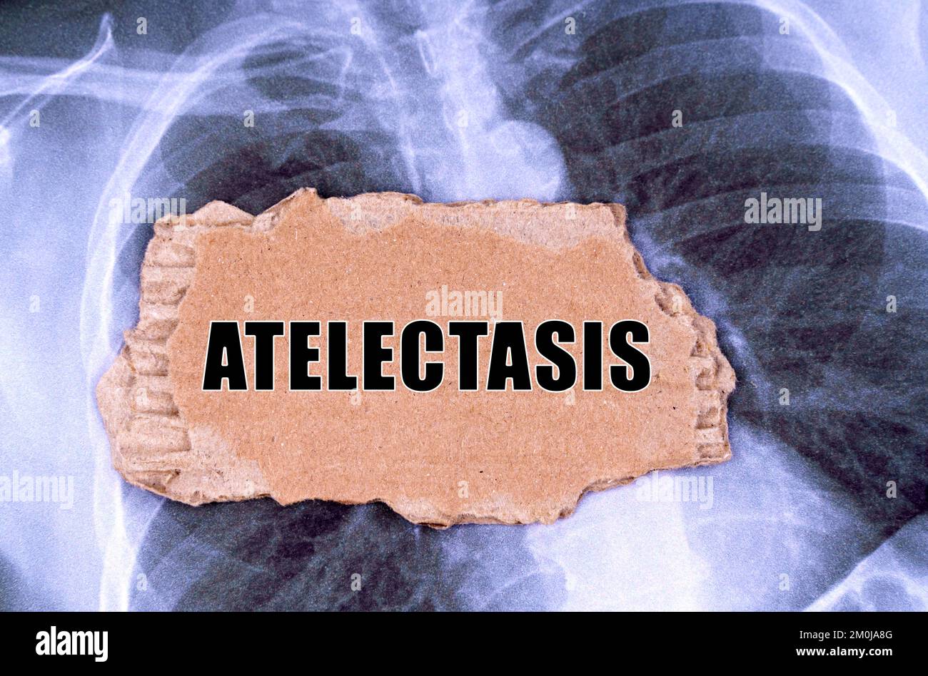 Medicine concept. On the X-ray there is a piece of cardboard with the inscription - Atelectasis ...