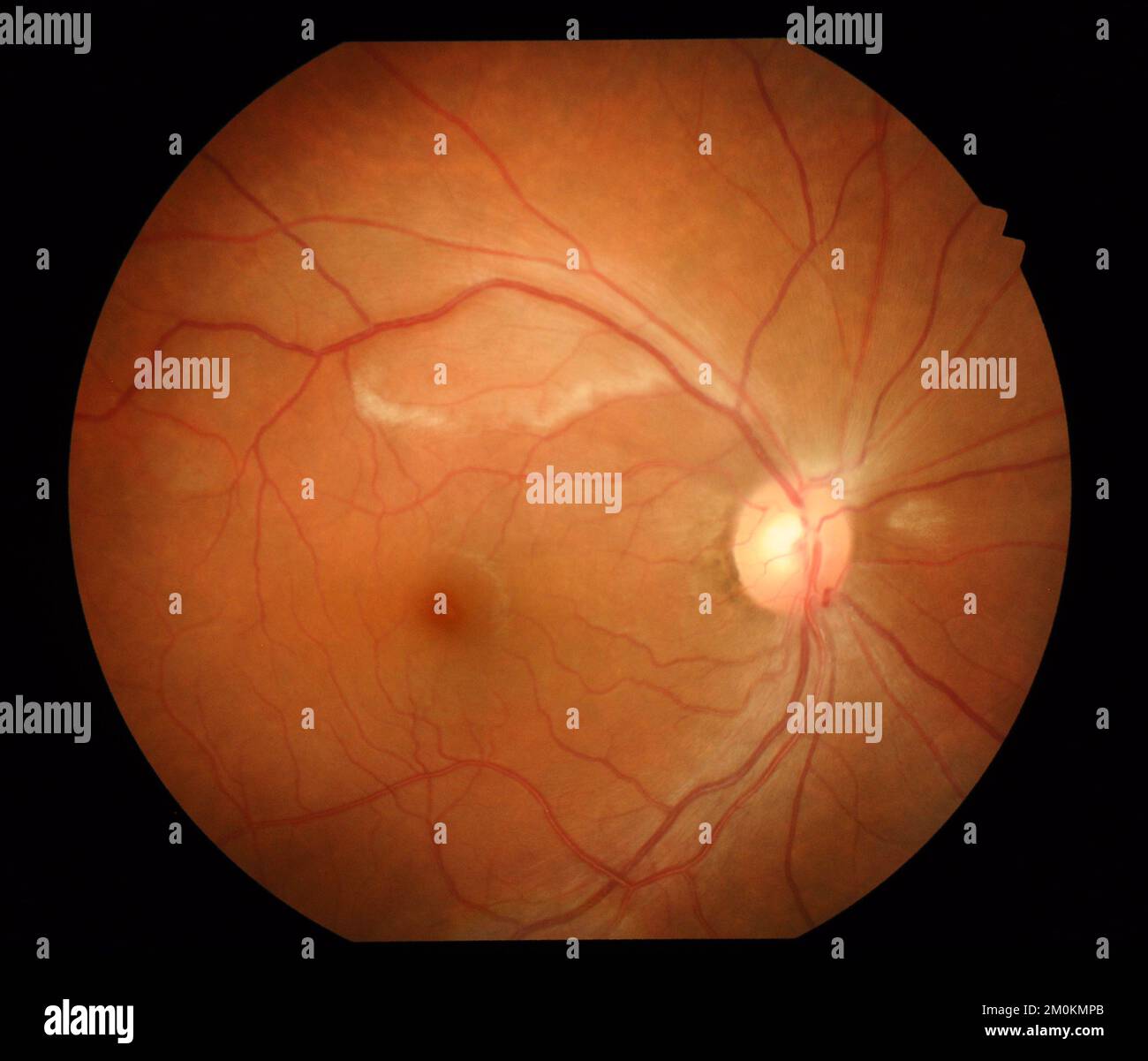 Retinal vasculitis, fundoscopy Stock Photo - Alamy