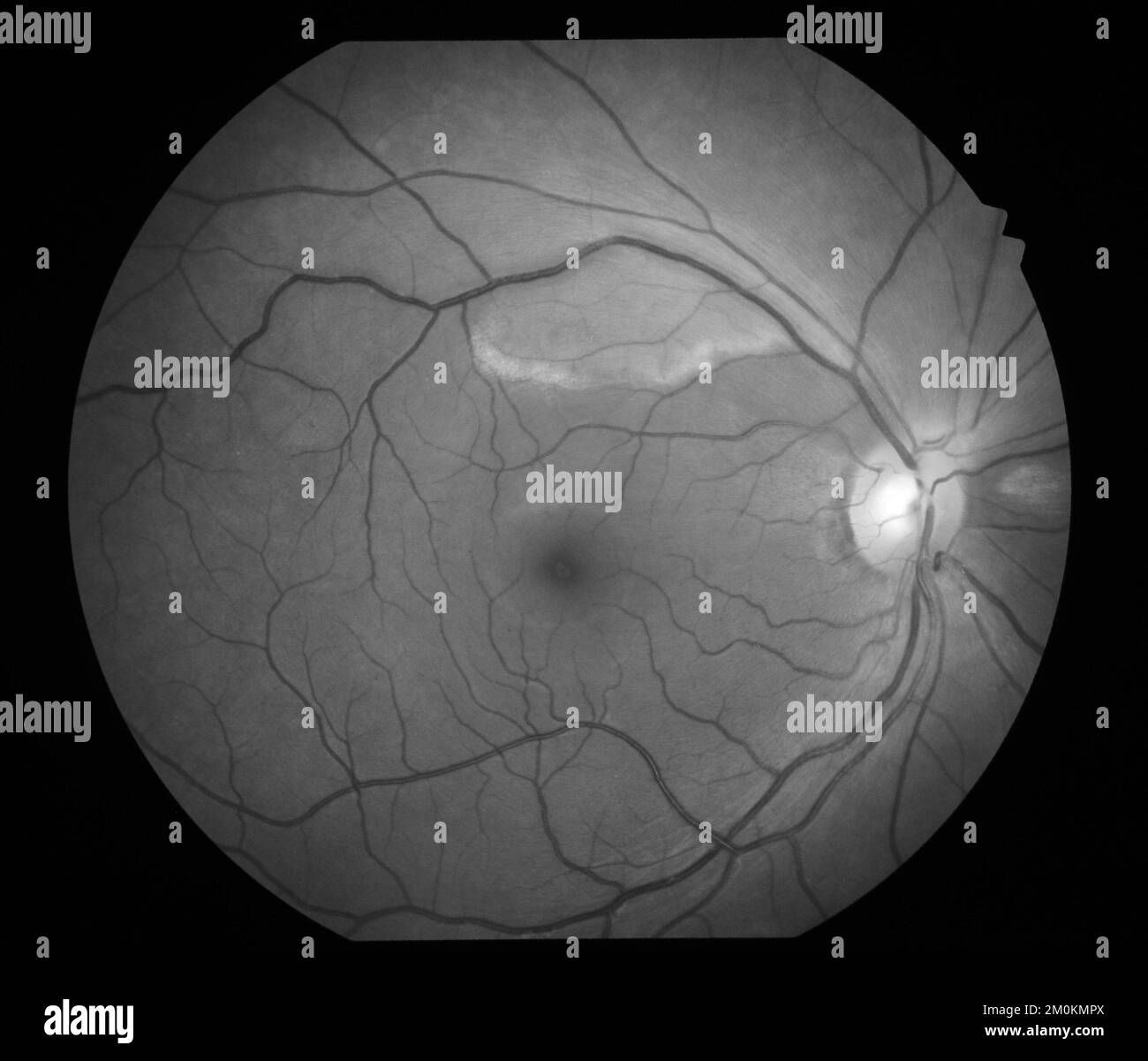 Retinal vasculitis, fundoscopy Stock Photo - Alamy