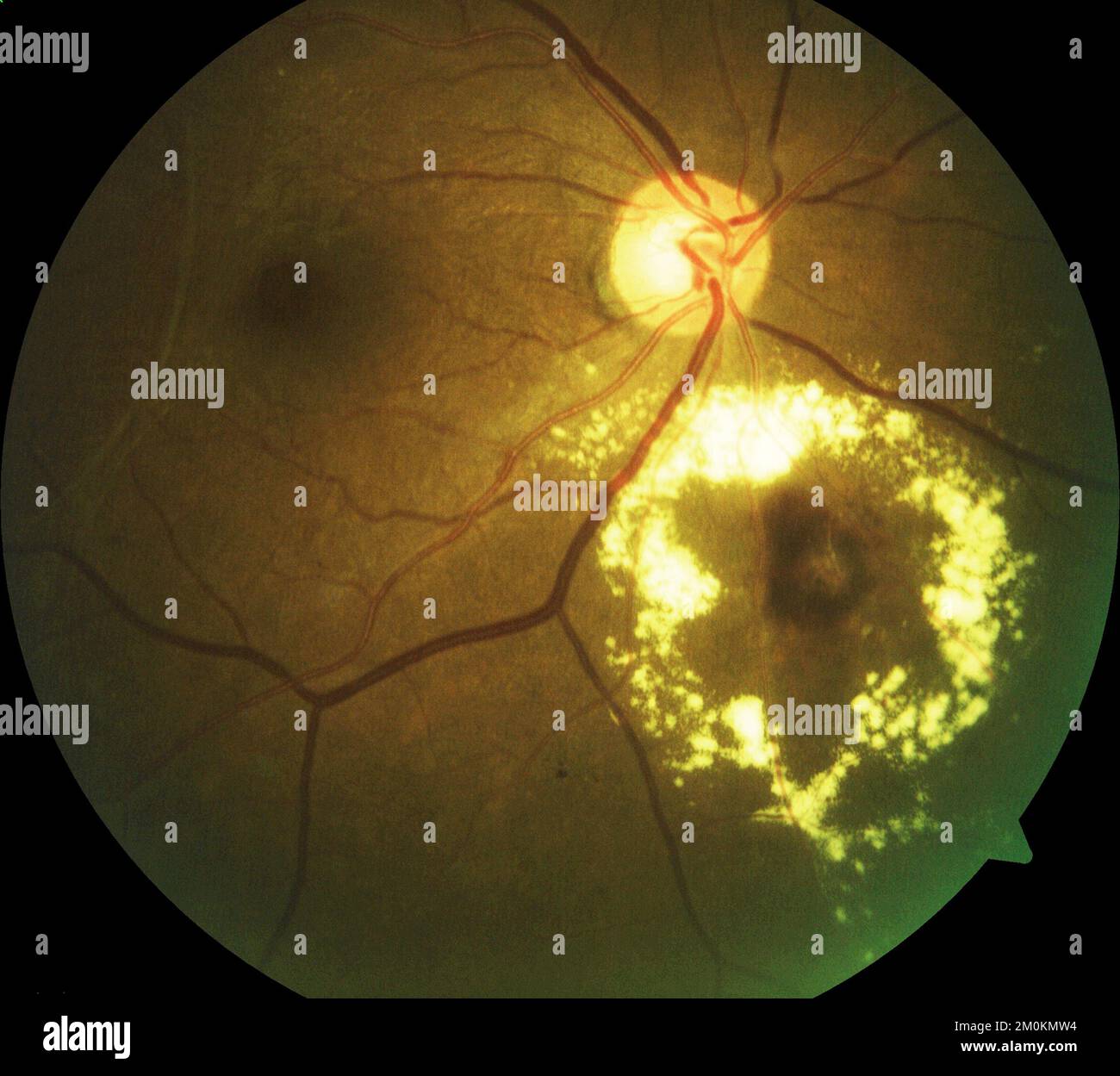 Vitreomacular traction, fundoscopy Stock Photo - Alamy