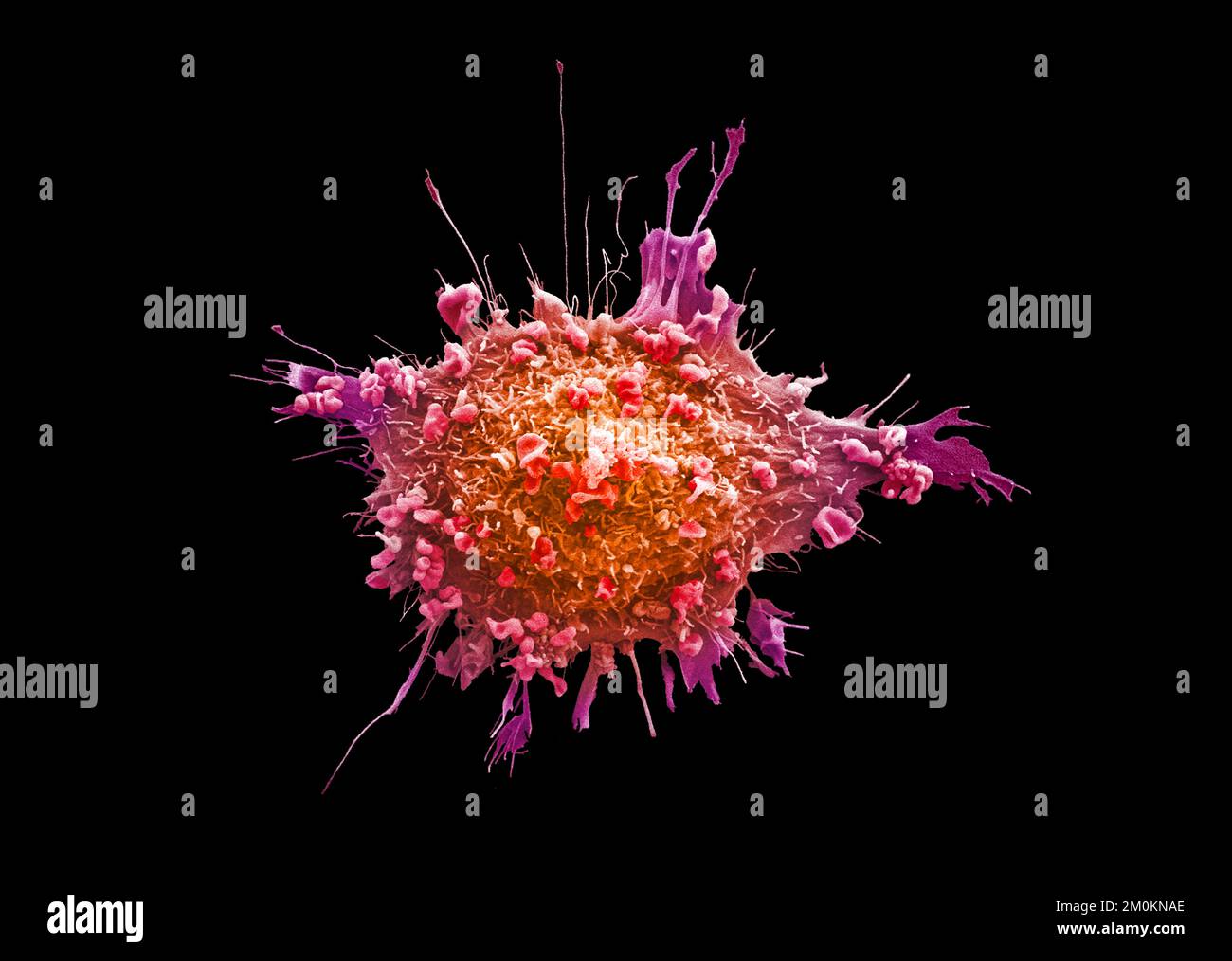 Cervical cancer cell, SEM Stock Photo - Alamy