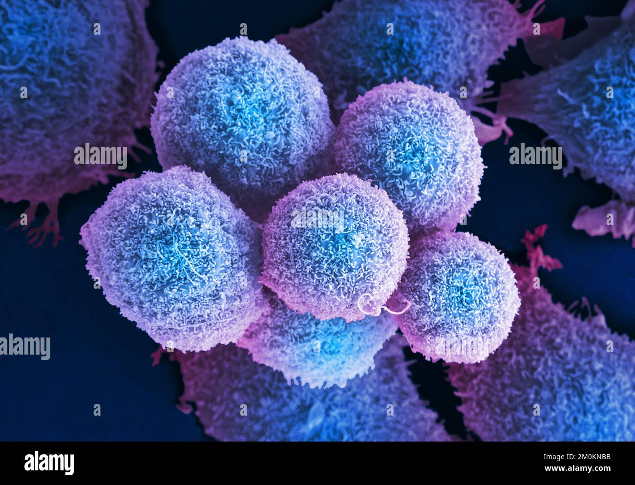 Lung cancer cells, SEM Stock Photo - Alamy
