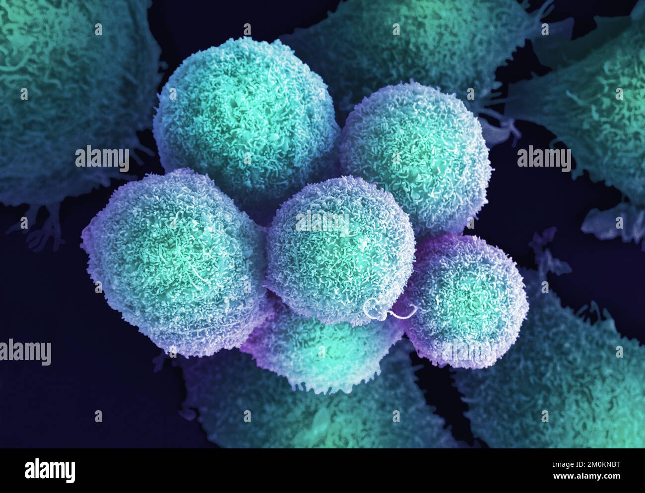 Lung cancer cells, SEM Stock Photo - Alamy