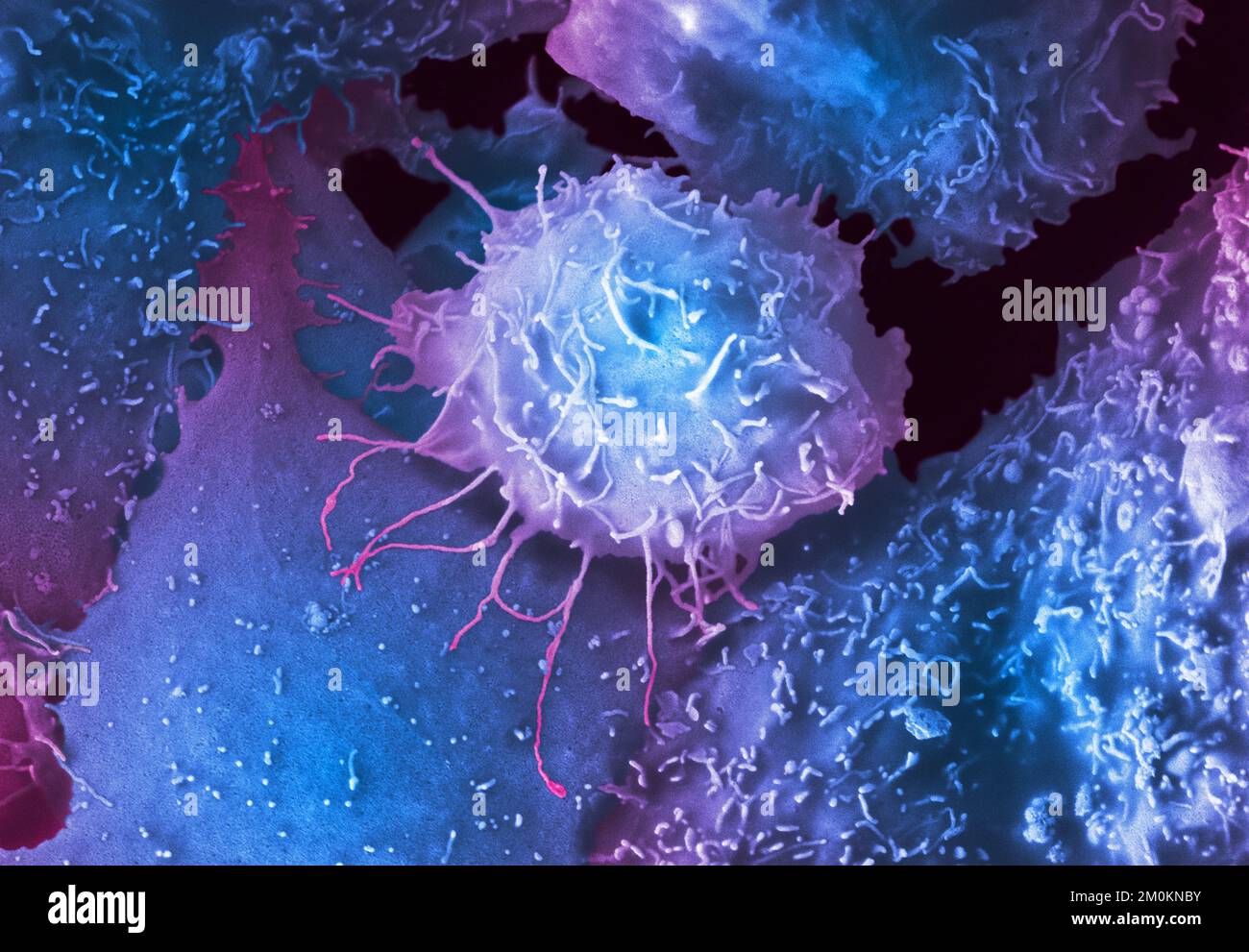 Prostate cancer cells, SEM Stock Photo - Alamy