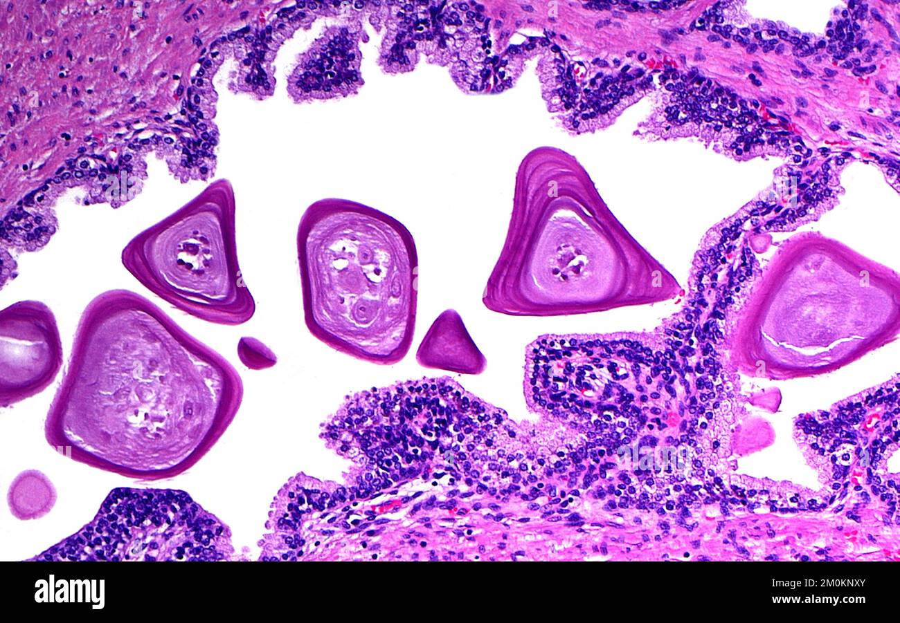 Prostate corpora amylacea, light micrograph Stock Photo - Alamy