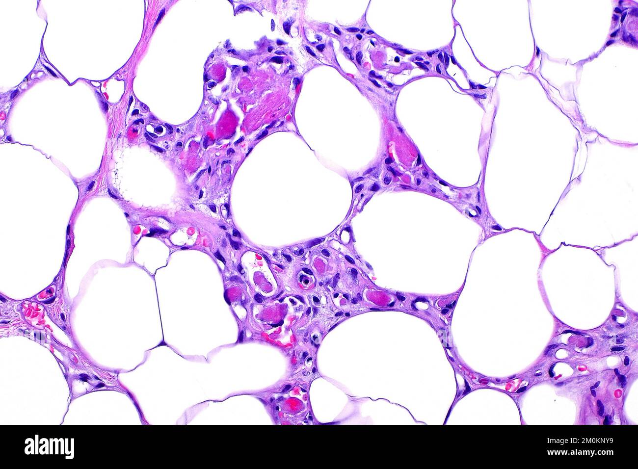 Angiolipoma benign fat tumour, light micrograph Stock Photo - Alamy