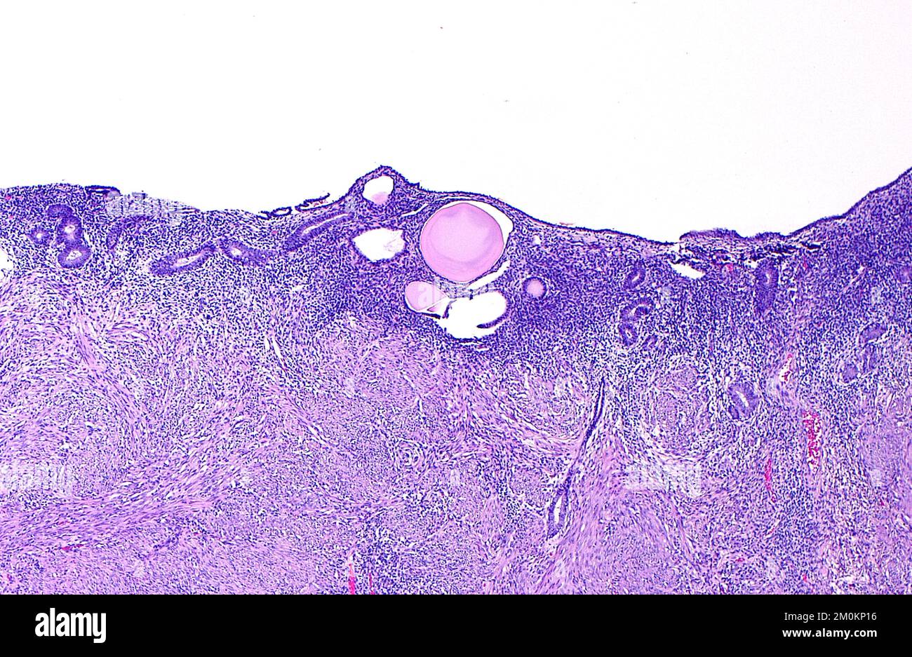 Uterus endometrium with atrophy, light micrograph Stock Photo - Alamy