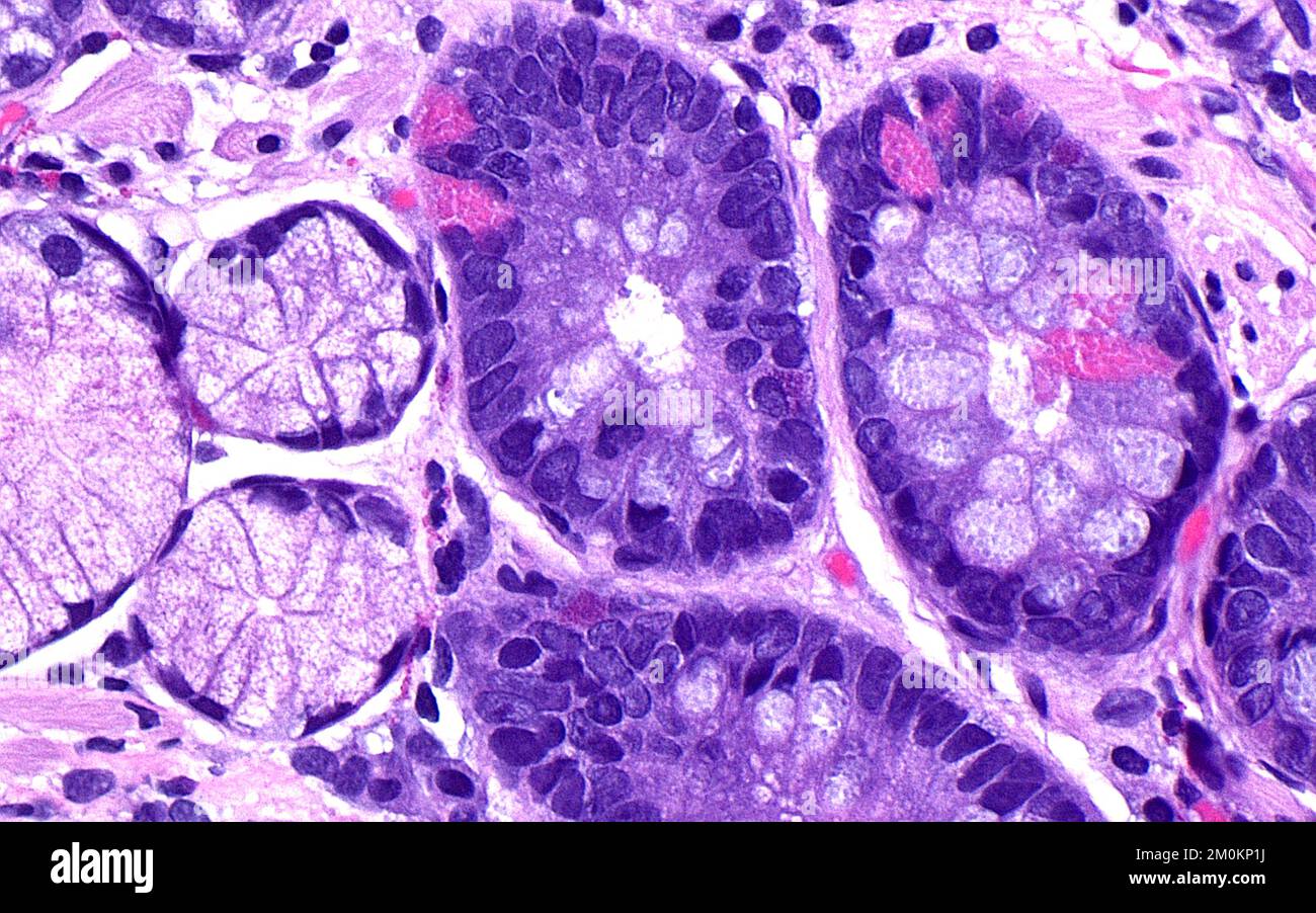 Intestinal metaplasia, light micrograph Stock Photo - Alamy