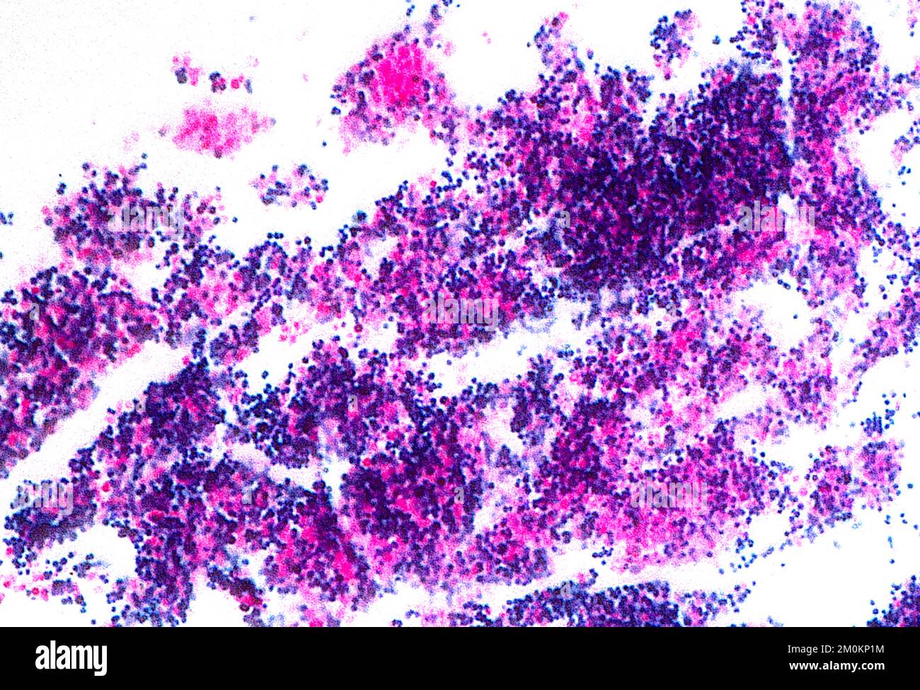 Bacterial infection, light micrograph Stock Photo - Alamy