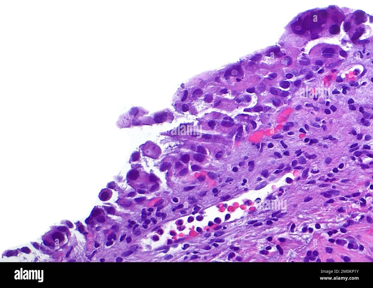 Bladder in situ cancer, light micrograph Stock Photo - Alamy