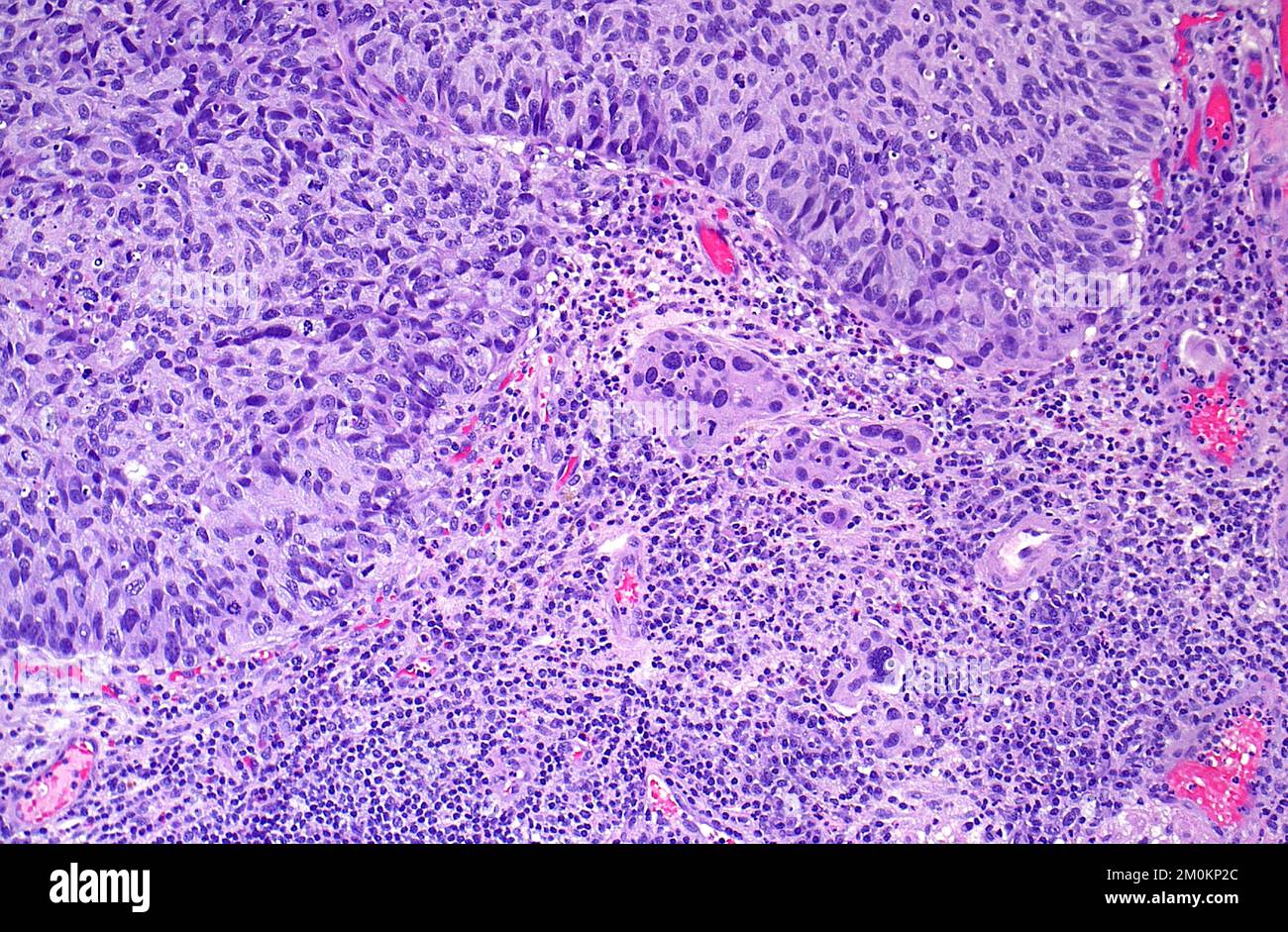 Bladder cancer invasion, light micrograph Stock Photo - Alamy