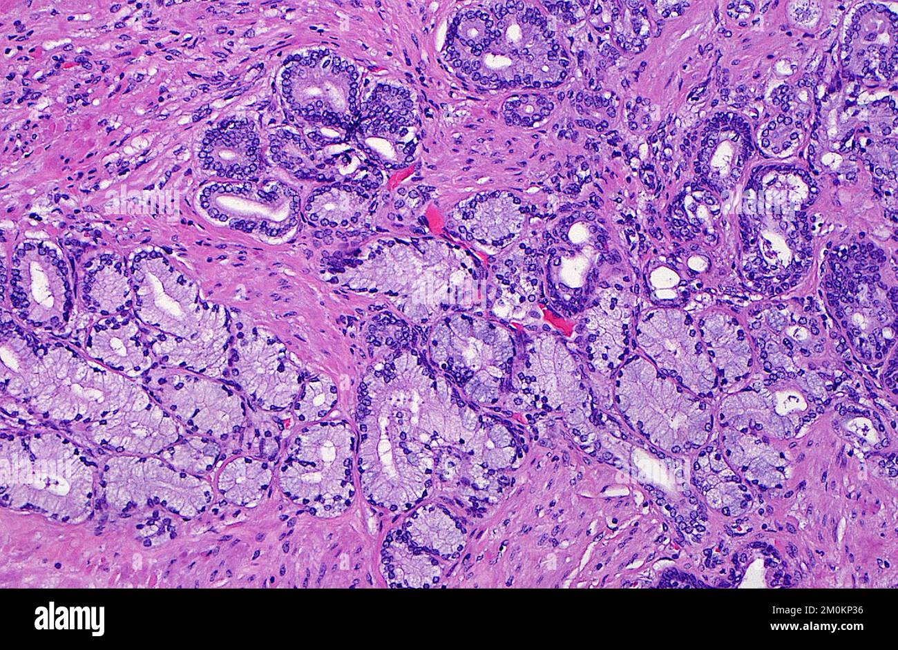 Prostate glands mucinous metaplasia, light micrograph Stock Photo - Alamy