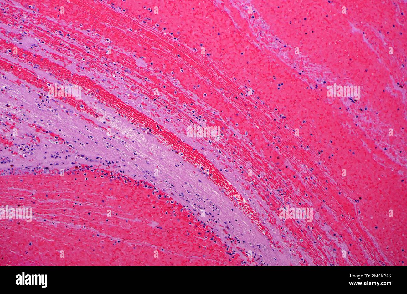 Blood clot, light micrograph Stock Photo - Alamy