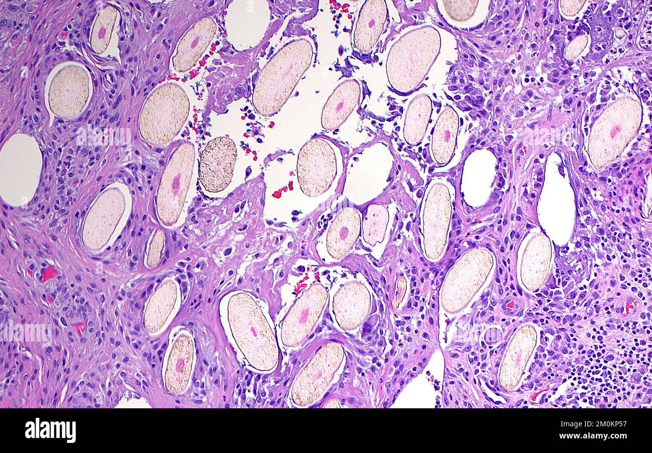 Pilonidal cyst, light micrograph Stock Photo - Alamy