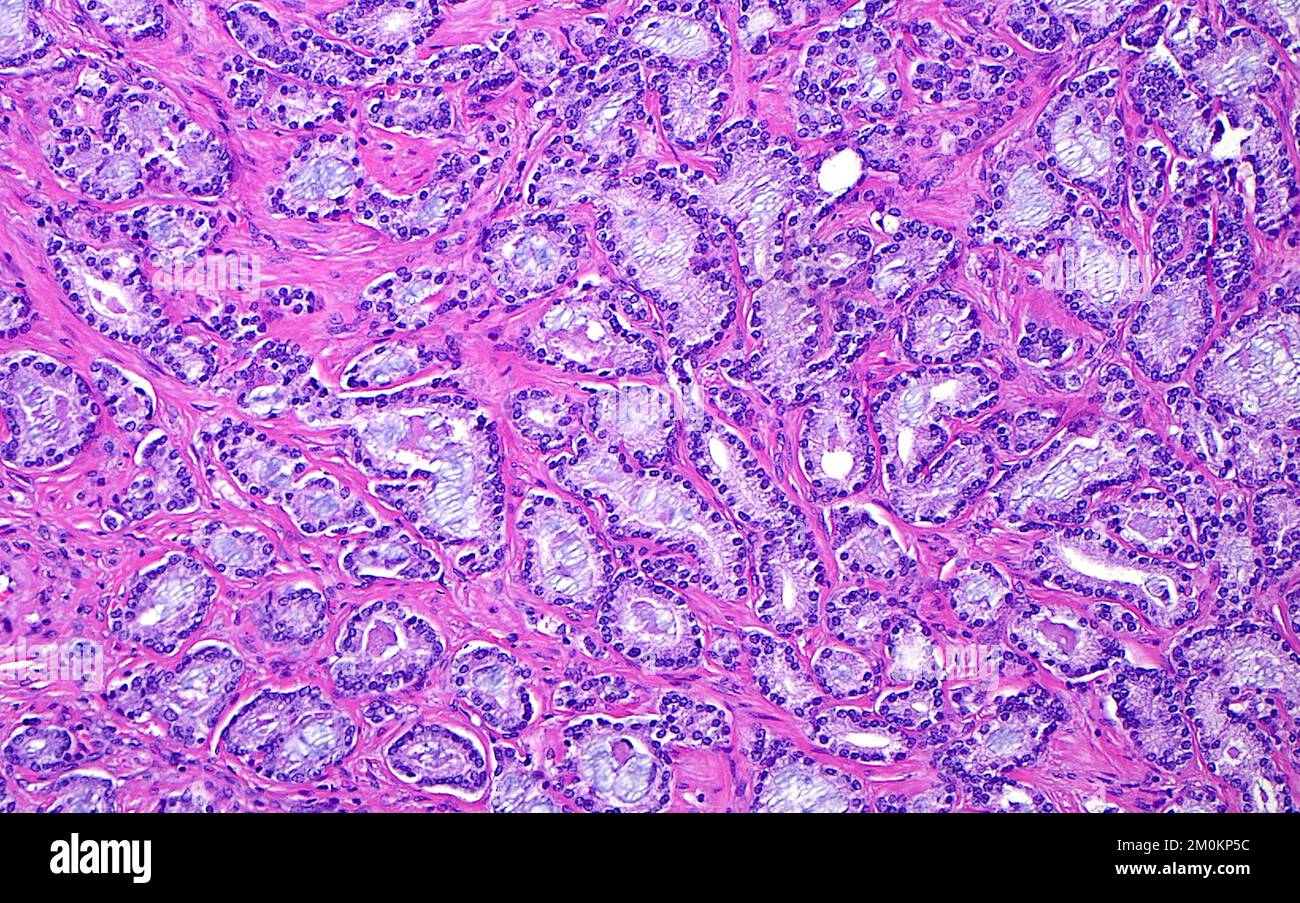 Prostate cancer, light micrograph Stock Photo - Alamy