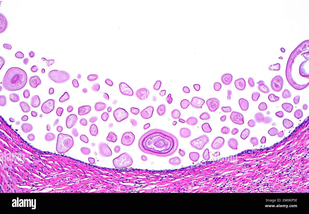 Prostate corpora amylacea, light micrograph Stock Photo - Alamy